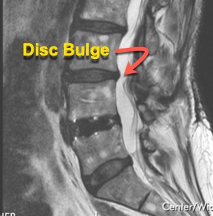 What is the most common lumbar MRI finding that correlates with an ...